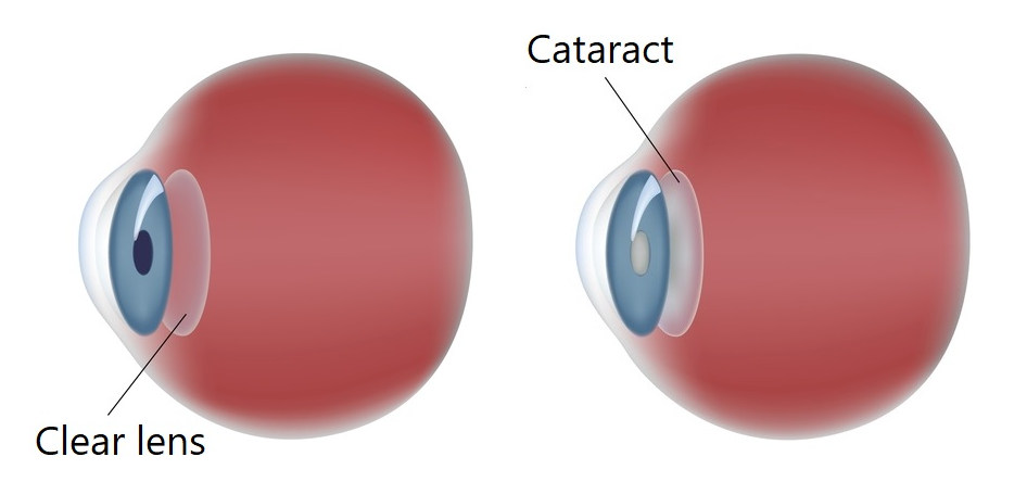 Cataract Eye Surgery, Birmingham: Cataract Removal Operation