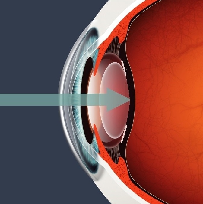 YAG Laser Capsulotomy Treatment - Laser Eye Surgery Birmingham