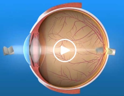 Presbyopia Treatment, Birmingham: Laser Eye Surgery
