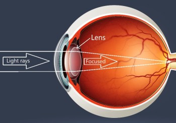 Cataract Eye Surgery, Birmingham: Cataract Removal Operation